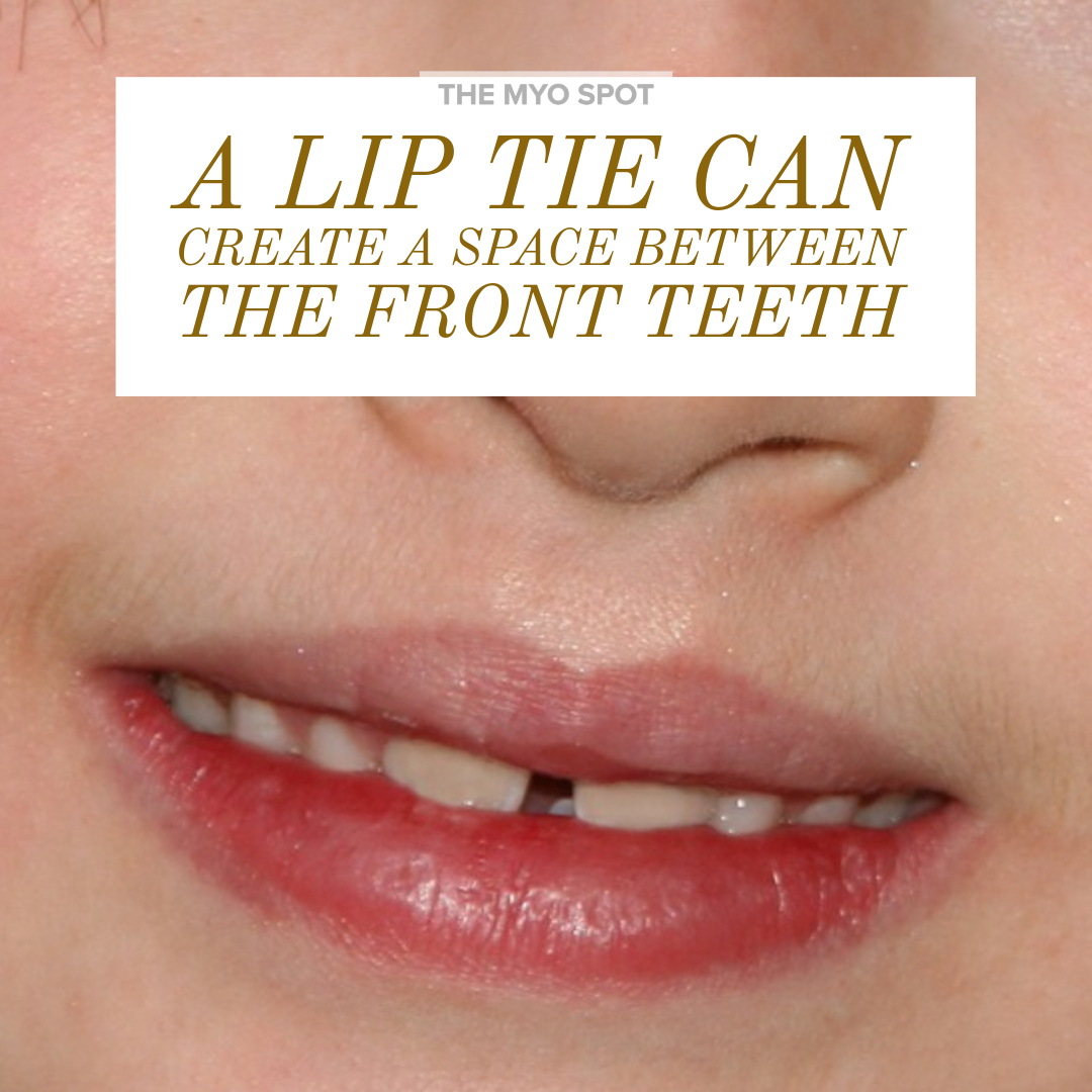 Myofunctional Therapy and Lip Ties: Advice for Every Age – Airway Matters